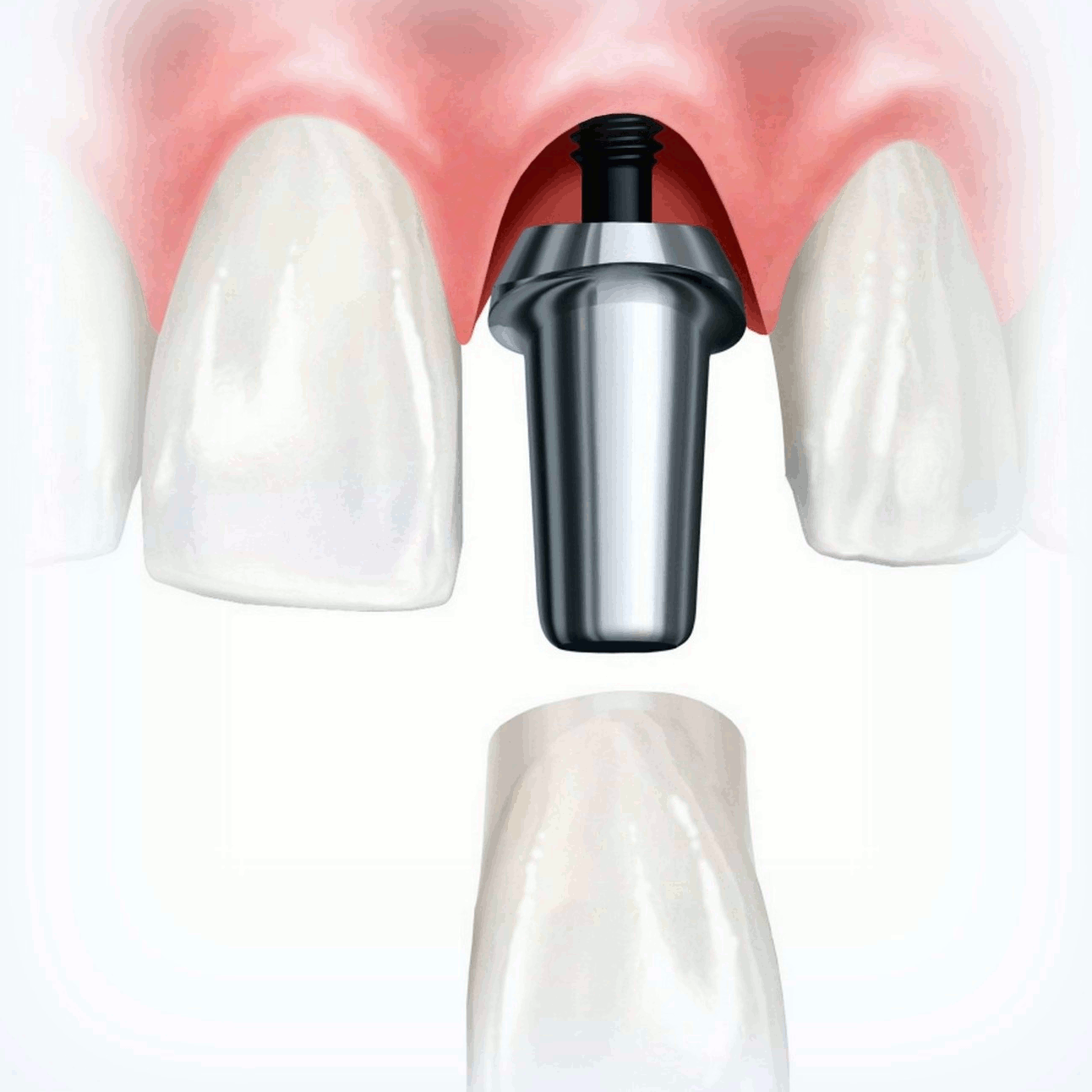 Implantes dentários, Lisboa - Porto - Setúbal. Benefício do implante ...